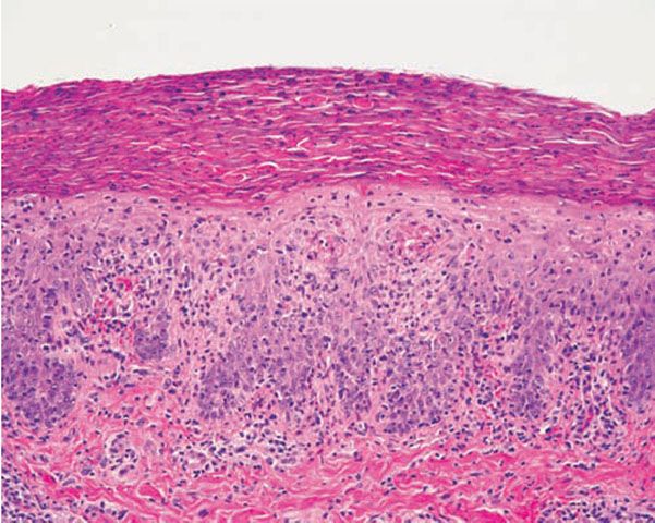 Noninfectious Erythematous, Papular, and Squamous Diseases | Plastic ...