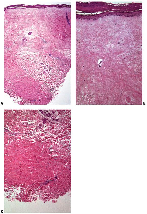 Connective Tissue Diseases | Plastic Surgery Key