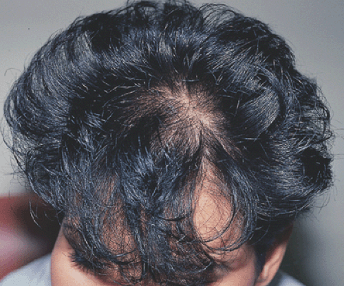 Telogen Effluvium | Plastic Surgery Key