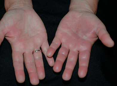28 ARTHROPOD BITES, STINGS, AND CUTANEOUS INFECTIONS | Plastic Surgery Key