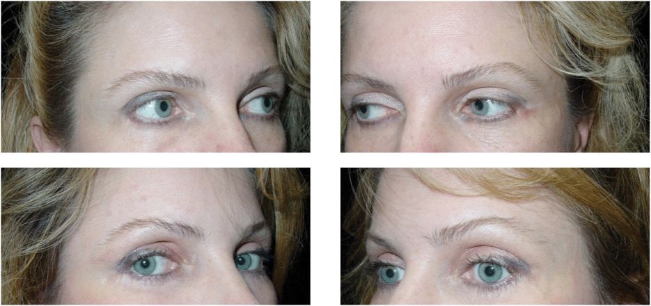 Facial Nerve Danger Zones | Plastic Surgery Key