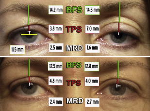Evaluation of Eyelid Function and Aesthetics | Plastic Surgery Key
