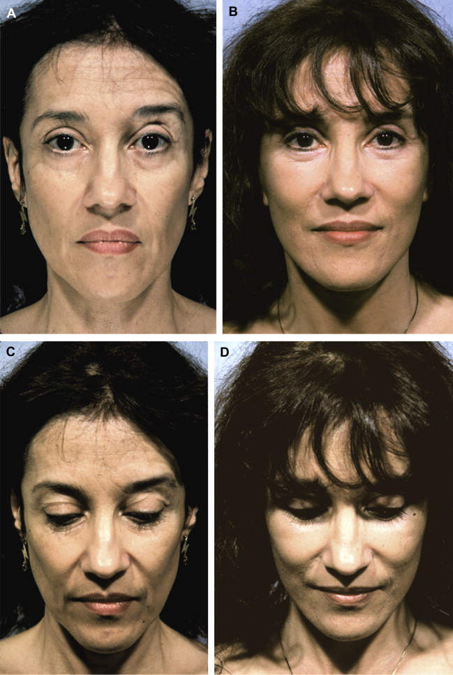 Midface Alloplastic Augmentation in the Asian and Latino Patient ...