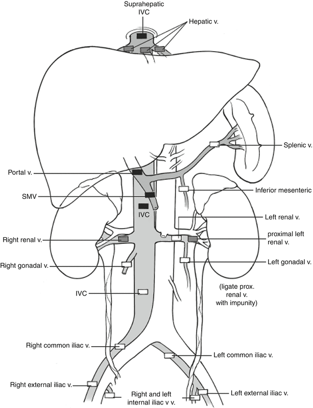 Major Abdominal Veins | Plastic Surgery Key