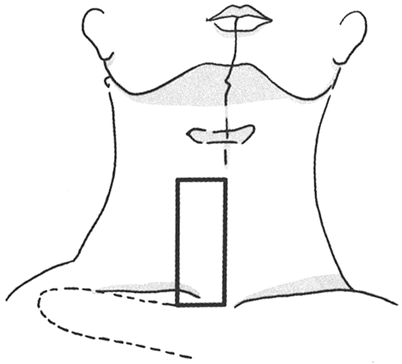 Defect Repair After Tongue Cancer Surgery | Plastic Surgery Key