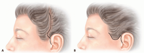 Lamellar High SMAS Face-Lift | Plastic Surgery Key