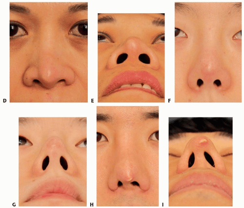 Technique for Dorsal Augmentation Using Alloplastic Material | Plastic ...