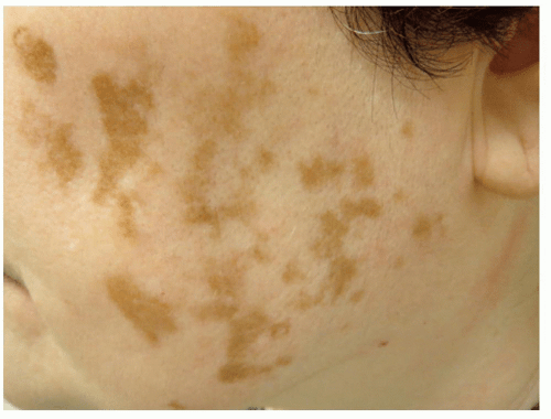 Vitiligo | Plastic Surgery Key