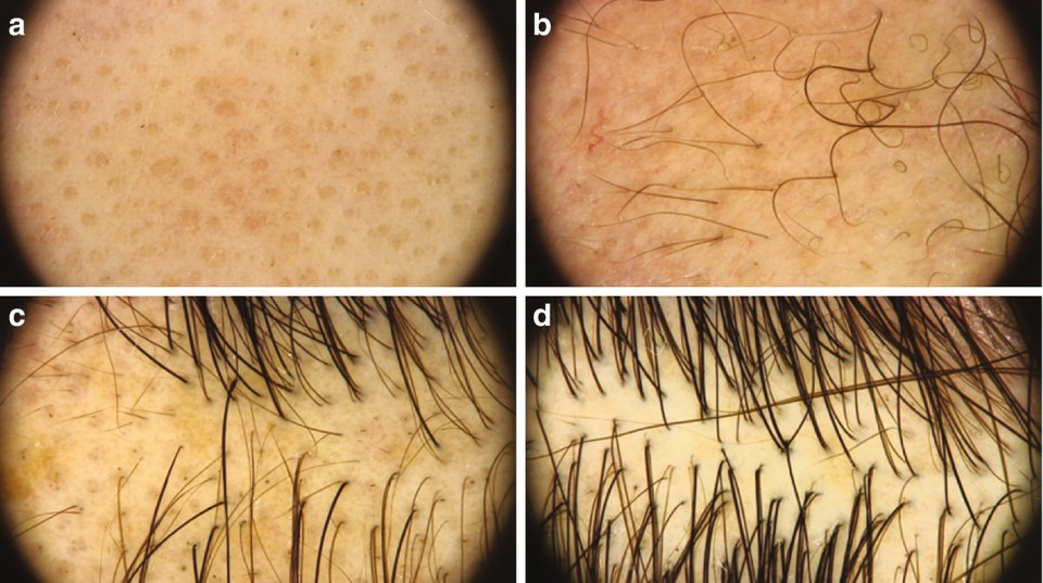 to Evaluate Treatment Response in Hair Diseases | Plastic Surgery Key