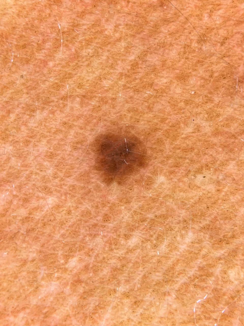 Pigmented Macules on Cheek and Neck | Plastic Surgery Key