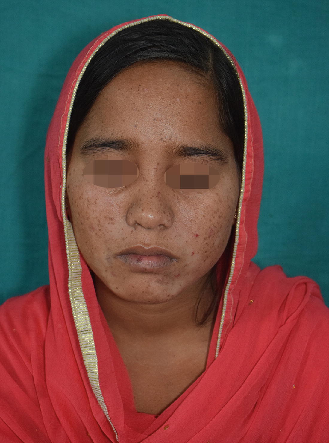Female with Multiple Pigmented Macules on Face | Plastic Surgery Key