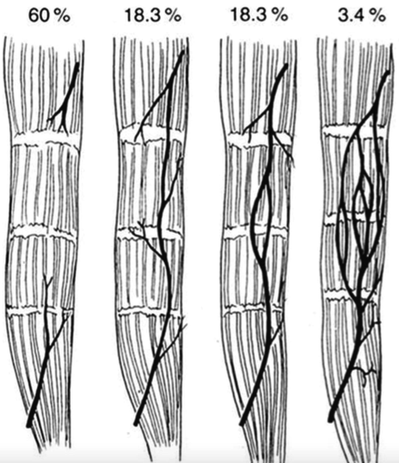 of Fasciocutaneous and Myocutaneous Flaps in Complex Urethral ...