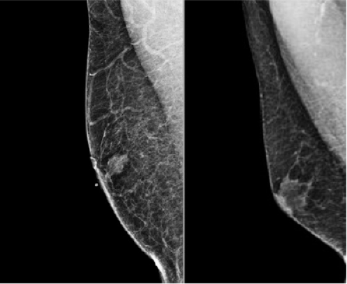 Male Breast Cancer: Surgery of the Breast | Plastic Surgery Key