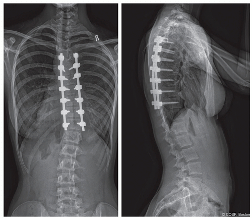 Posterior Fusion for Idiopathic Scoliosis | Plastic Surgery Key