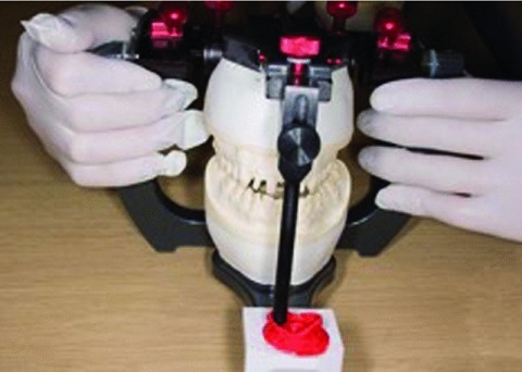 Facebows: The Facebow Recording | Pocket Dentistry