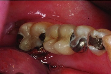 Adhesive Bridges | Pocket Dentistry