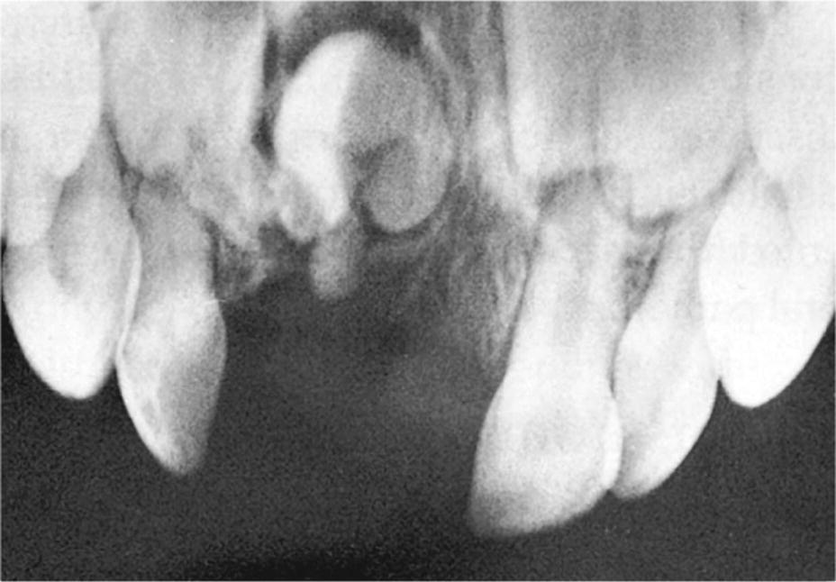 4: Tooth Development and Disturbances in Number and Shape of Teeth ...