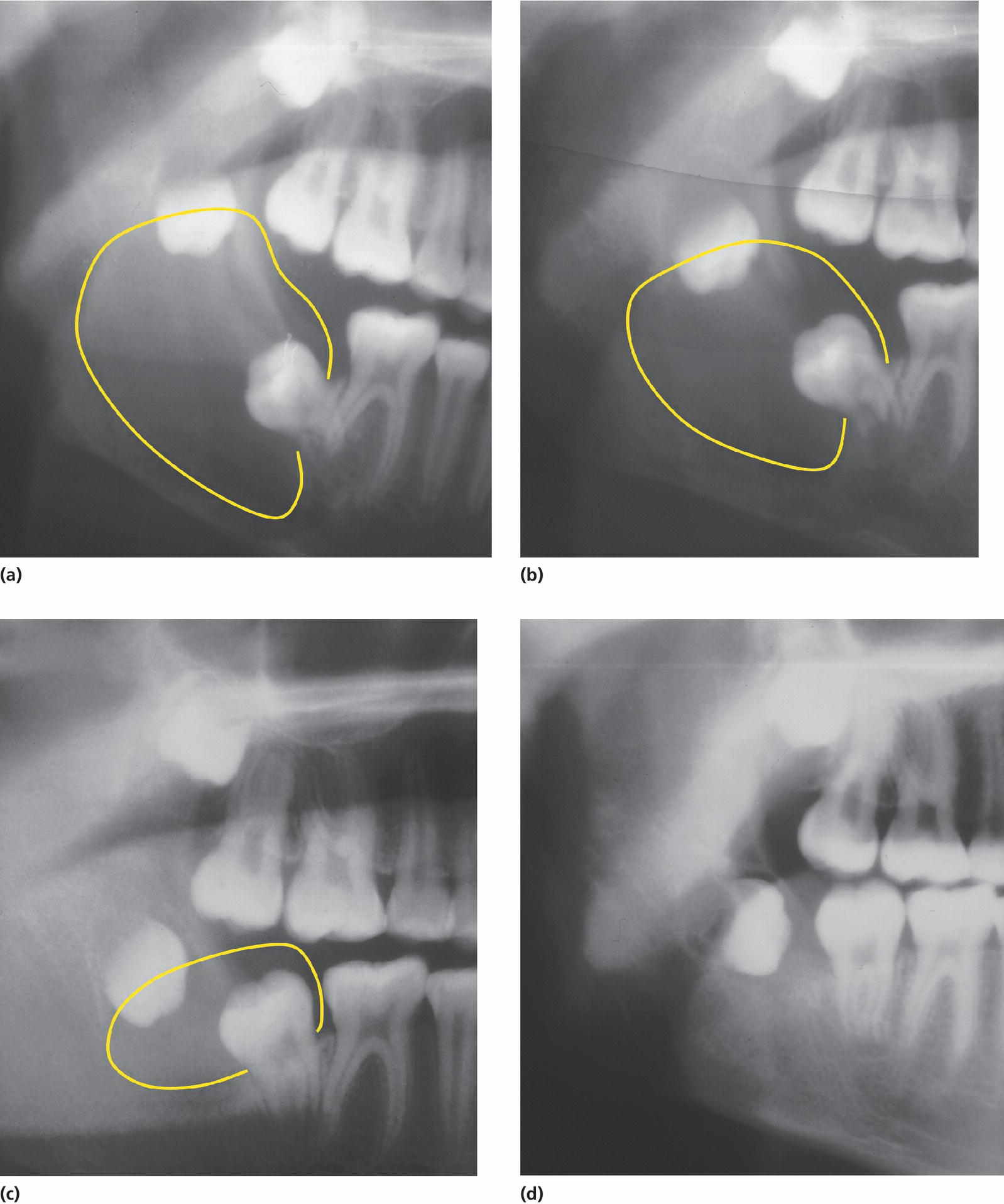 5: Eruption and Shedding of Teeth | Pocket Dentistry