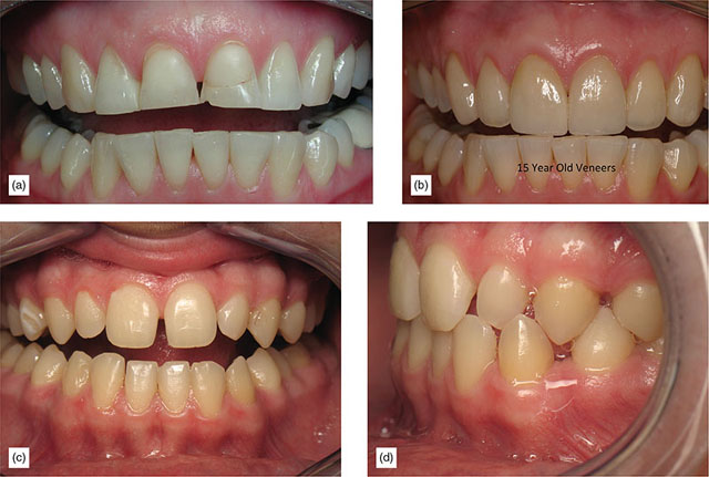 The Importance of Occlusion and Occlusal Diagnosis in Restorative ...
