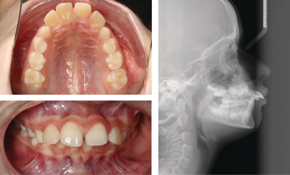 Treatment for Class II Malocclusion | Pocket Dentistry