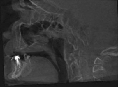 Radiographic Complications and Evaluation | Pocket Dentistry