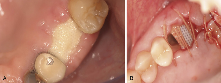 Bone Grafting Complications | Pocket Dentistry