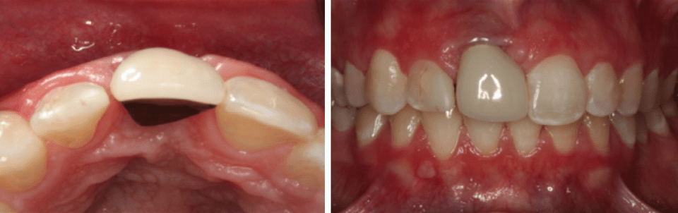 Soft Tissue Deficiencies | Pocket Dentistry