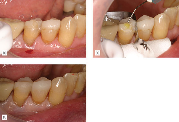 Supragingival Minimally Invasive Bonded Onlays: The Replacement for ...