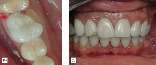 The Importance of Occlusion and Occlusal Diagnosis in Restorative ...