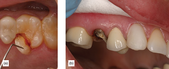 The Importance of Occlusion and Occlusal Diagnosis in Restorative ...