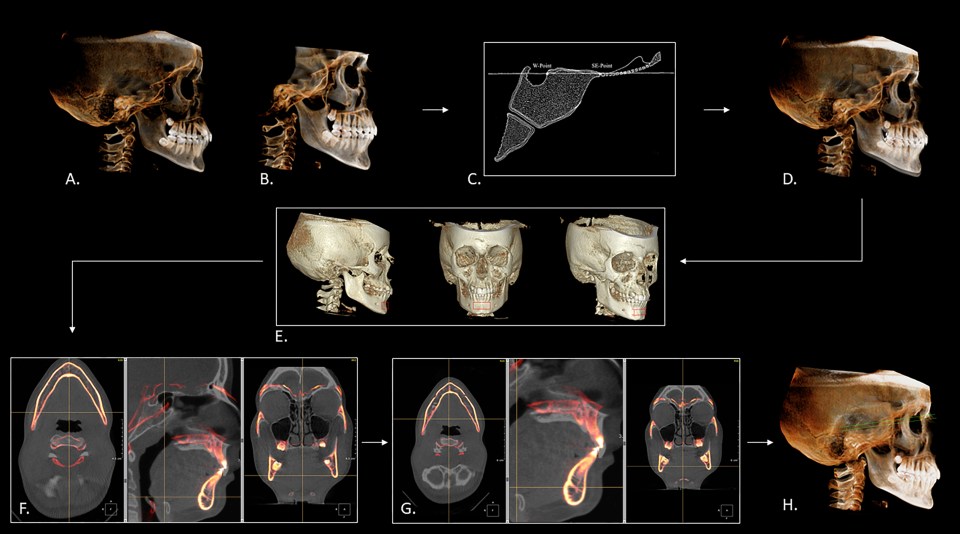 A comparison of 2- and 3-dimensional mandibular superimposition ...