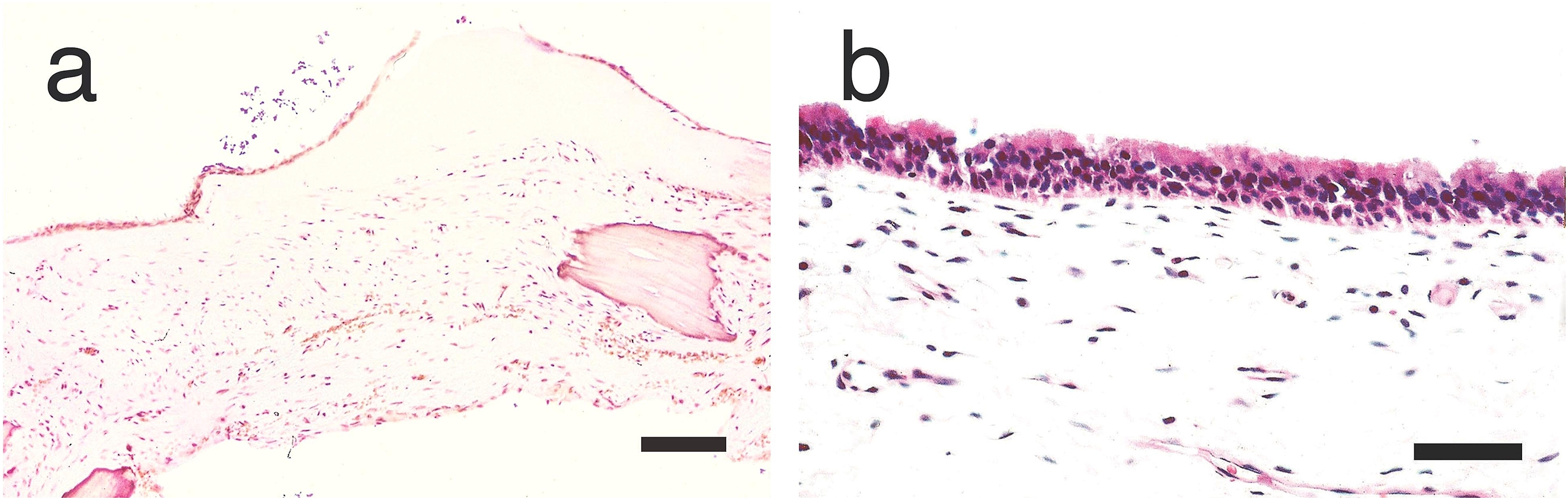 Surgical ciliated cyst of the maxilla: Report of two cases with ...