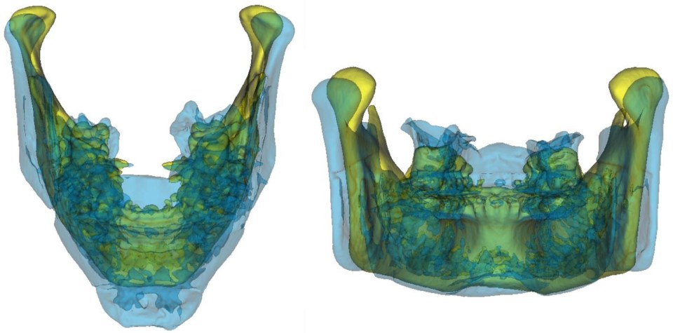 Long-term stability and condylar remodeling after mandibular ...