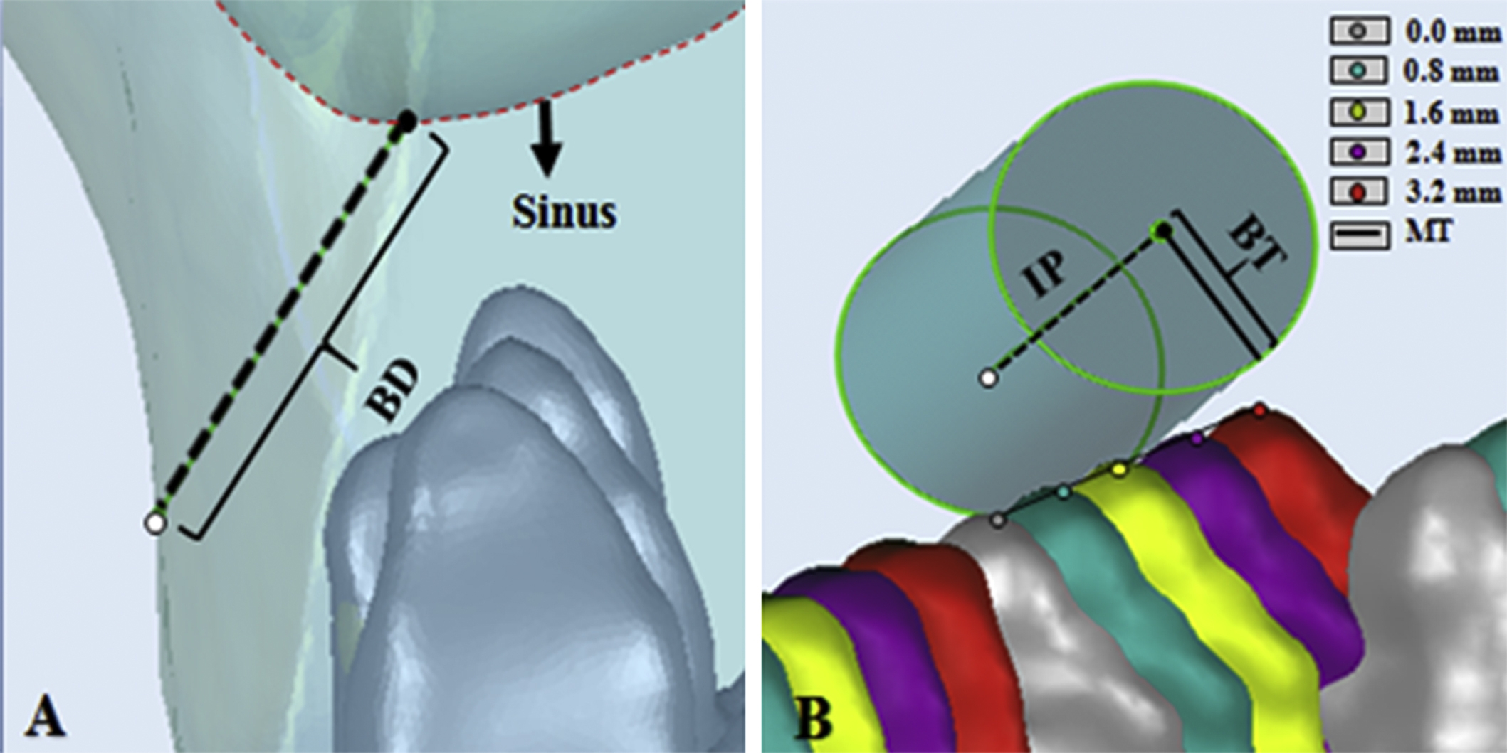 Bone depth and thickness of different infrazygomatic crest miniscrew ...