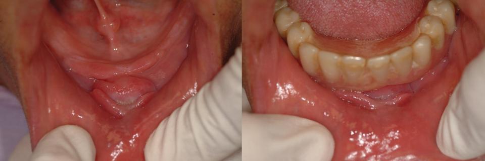 Benign Lesions of the Oral Cavity and the Jaws | Pocket Dentistry