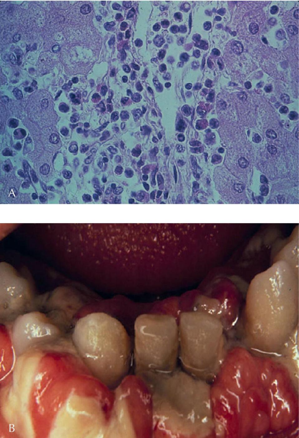 Oral Complications of Nonsurgical Cancer Therapies | Pocket Dentistry