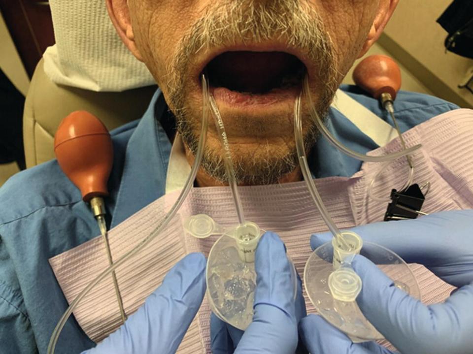 Salivary Gland Diseases | Pocket Dentistry