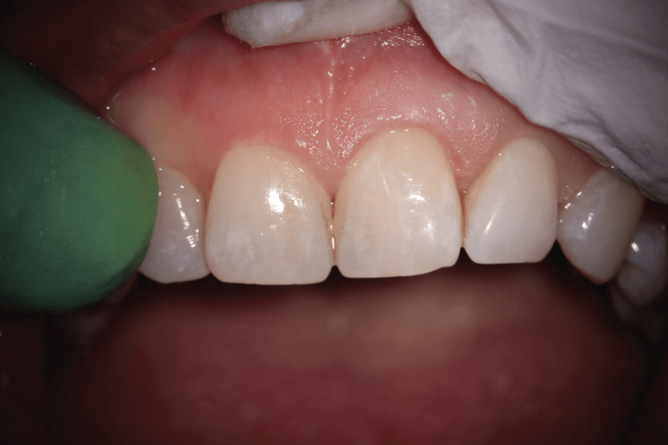 Repair of Pulp Chamber and Root Perforations | Pocket Dentistry