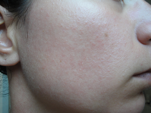 Bouton Sur Joue Au Dessus De La Peau - Meganseutro