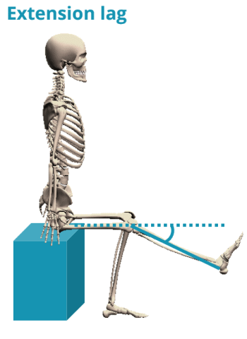 理学療法士の視点でExtension lag（エクステンションラグ）の原因を考える | 理学療法士・作業療法士のためのスキルアップノート