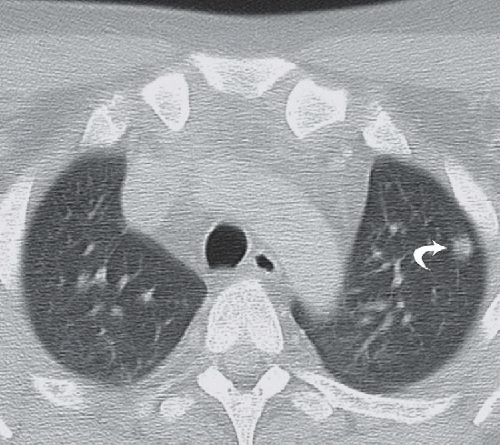 Lemierre’s Syndrome | Radiology Key
