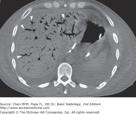Chapter 8. Plain Film of the Abdomen | Radiology Key