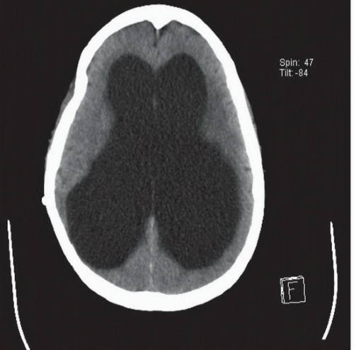 Ventriculoperitoneal Shunt Malfunction | Radiology Key