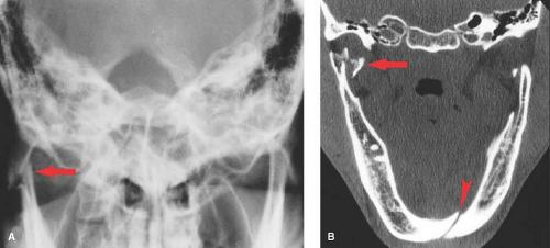 Craniofacial Trauma | Radiology Key