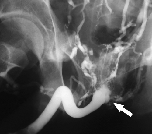 Pelvicalyceal System, Ureters, Bladder, and Urethra | Radiology Key