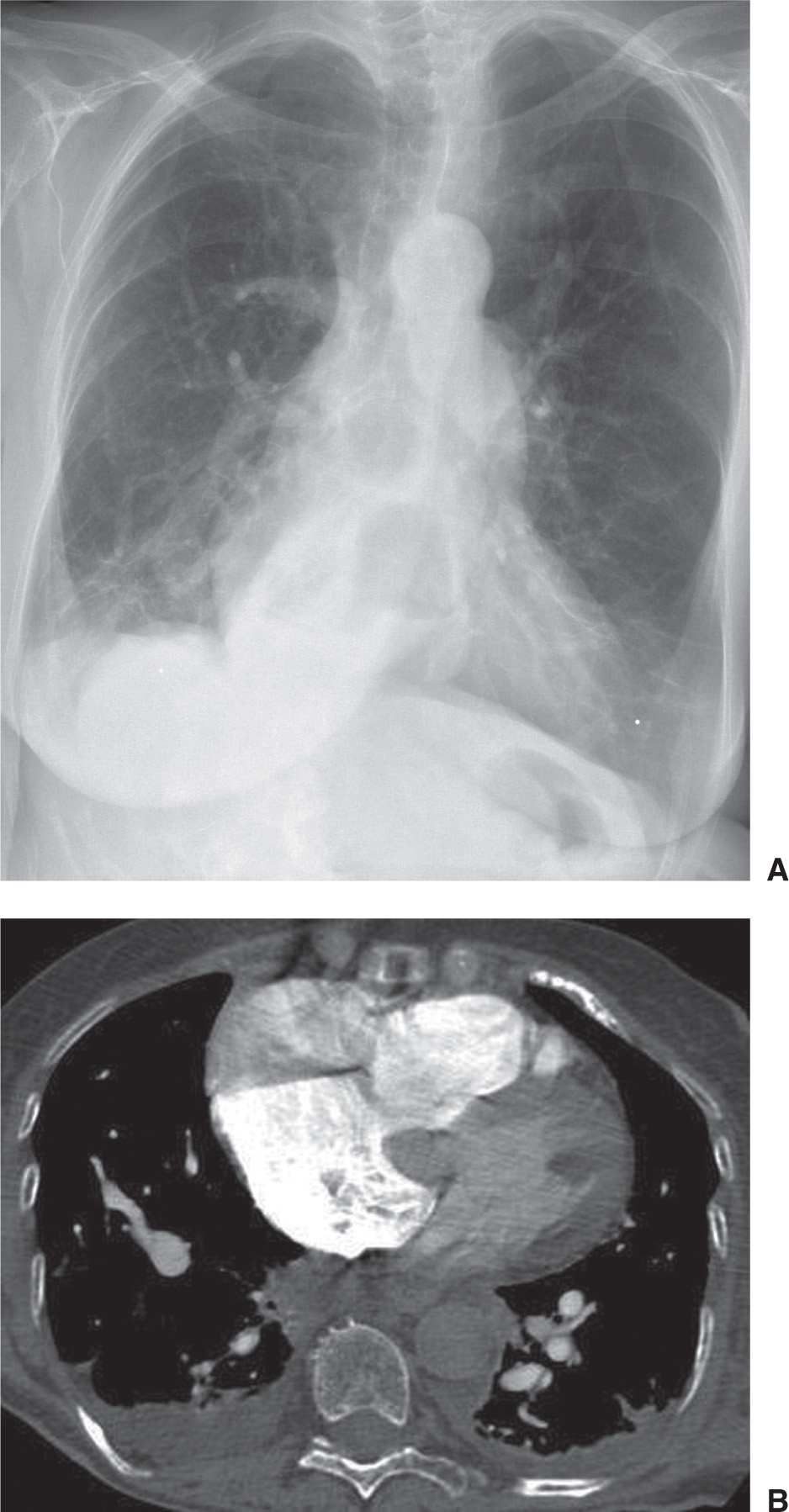 Congenital Lung Disease | Radiology Key