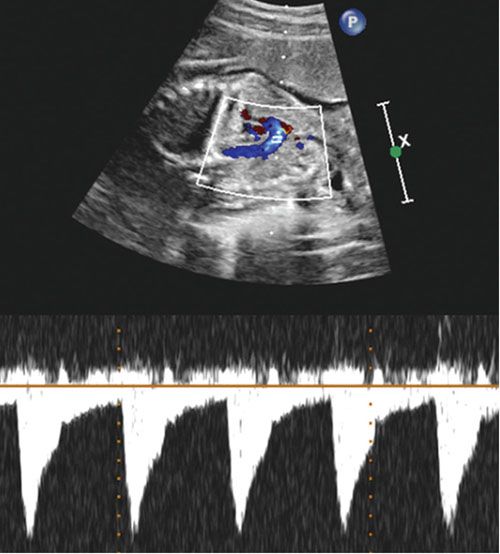 Normal Fetal Heart Survey | Radiology Key