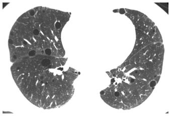 Decreased Lung Attenuation: Emphysema, Mosaic Perfusion, and Cystic ...