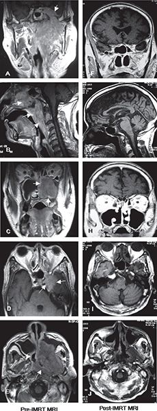 Nasopharynx | Radiology Key