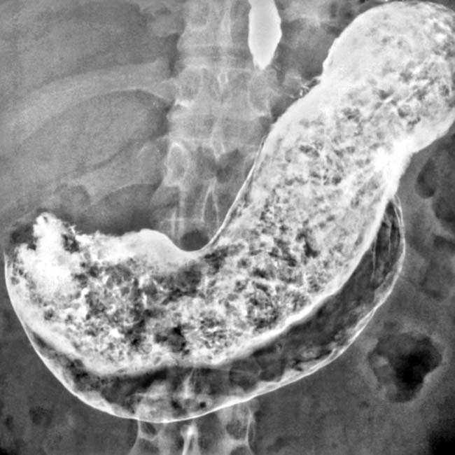 Gastric Bezoar | Radiology Key